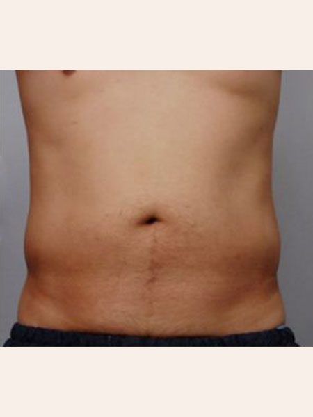 Ultraformer 3 London, Cheshire & Liverpool | Dr Nyla Medispa