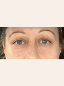 NuEra Tight | NuEra Skin Tightening | Dr Nyla Medispa