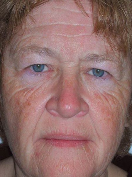 UltraPulse® CO2 Laser Skin Resurfacing - London, Cheshire & Liverpool