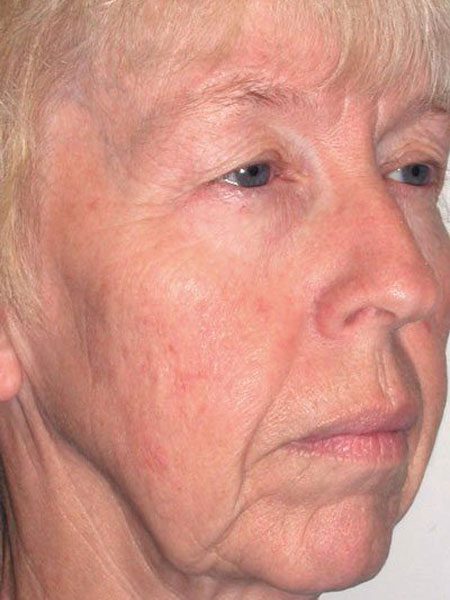 UltraPulse® CO2 Laser Skin Resurfacing - London, Cheshire & Liverpool