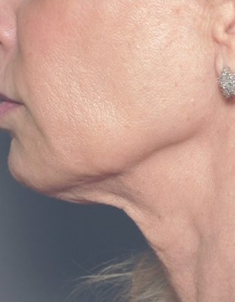 Treatments for Saggy Neck & Neck Skin Wrinkles | Dr Nyla Medispa