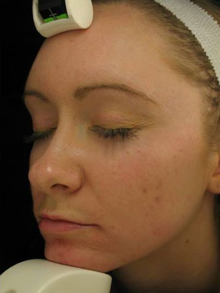 Dermalux LED Light Therapy | Dr Nyla Raja Medispa