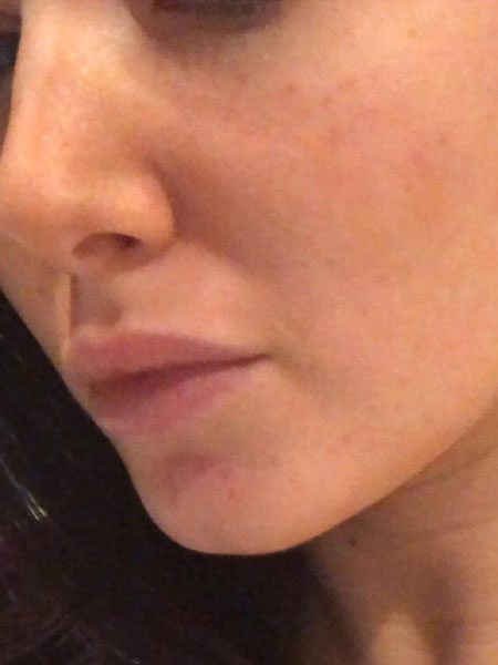 ENVY Facial - London, Cheshire & Liverpool | Dr Nyla