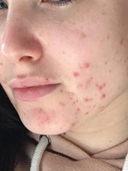 ENVY Facial - London, Cheshire & Liverpool | Dr Nyla