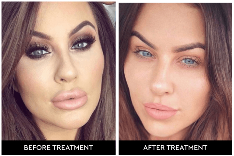 Dissolving Lip Fillers London - Doctor Nyla Medispa