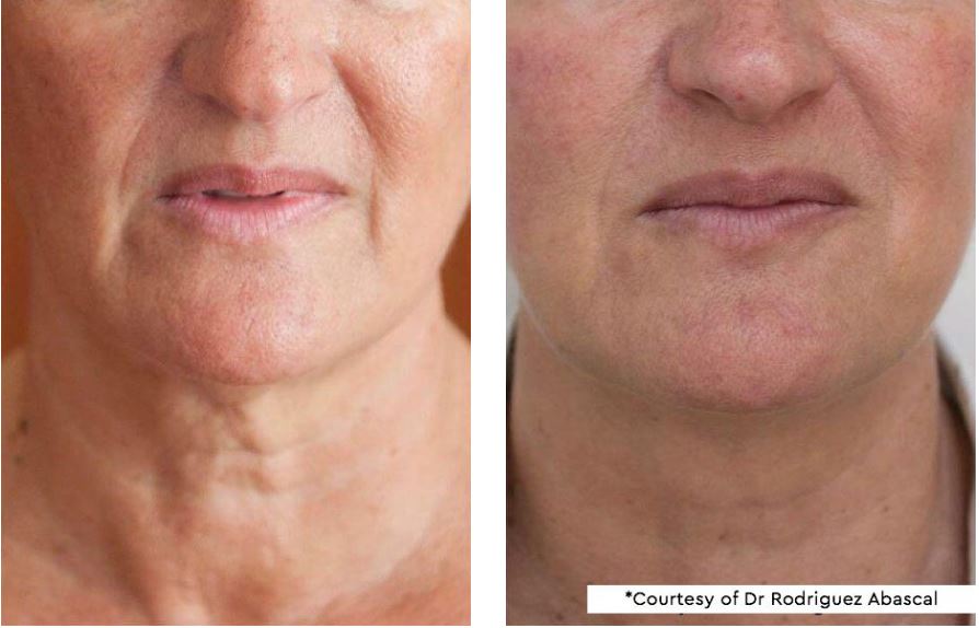 Menopause Skin Care and Non-Surgical Treatments | Dr Nyla Medispa