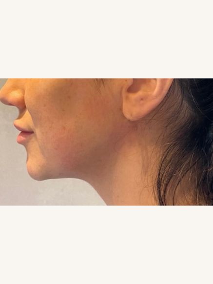 Non-Surgical Facial Fat Loss | Double Chin Treatment at Dr Nyla Medispa