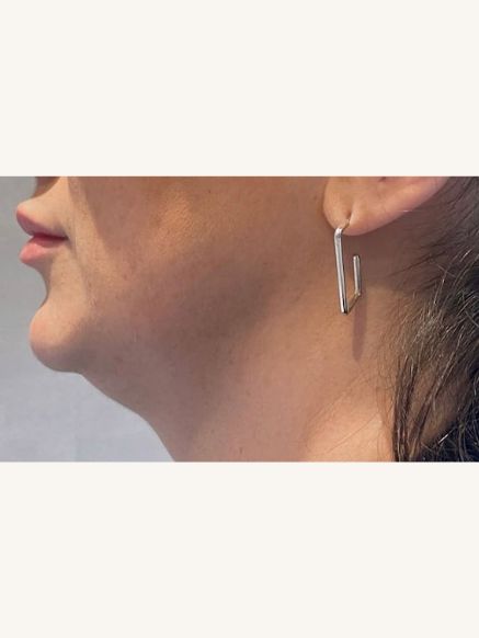 Non-Surgical Facial Fat Loss | Double Chin Treatment at Dr Nyla Medispa