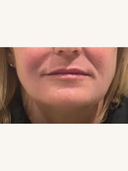 Sagging Jowls Treatment London | Sagging Jowls Before & After Images