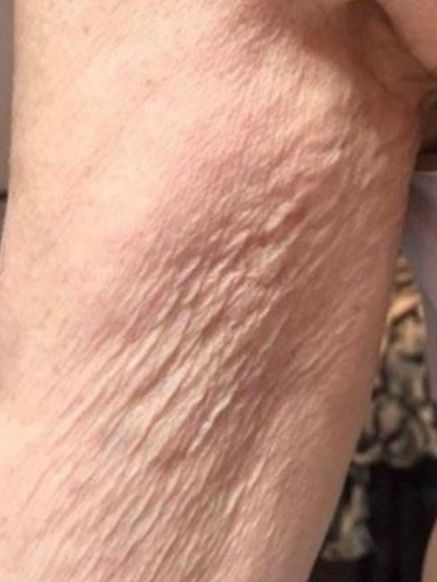 Non-Surgical Ways to Lose Fat from Legs & Tighten Loose Leg Skin