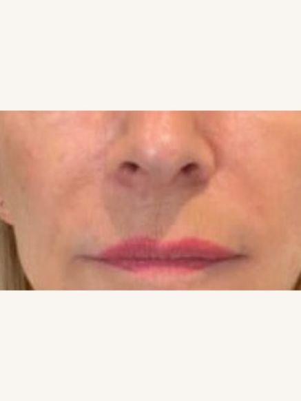 How to Minimise Smile Lines | Nasolabial Folds Causes & Treatment
