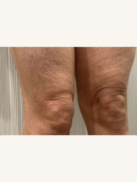 Leg Treatments in London, Cheshire & Liverpool | Dr Nyla Medispa