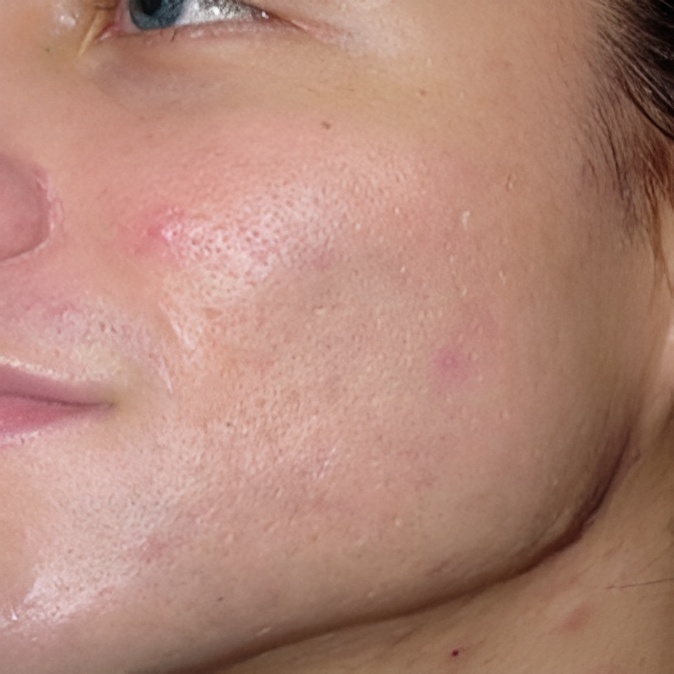 ENVY Facial - London, Cheshire & Liverpool | Dr Nyla Medispa